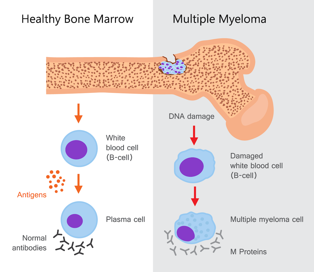 Multiple Myeloma Program Rutgers Cancer Institute Of New Jersey